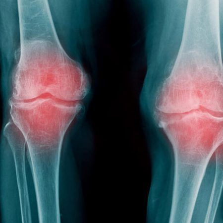 Los grados de la artrosis de rodilla - ITRAMED