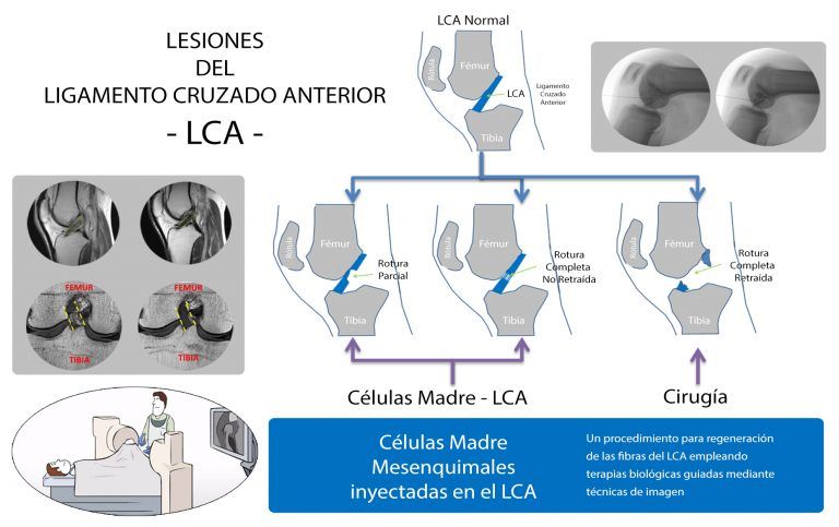 Lesiones de los ligamentos de la rodilla - ITRAMED