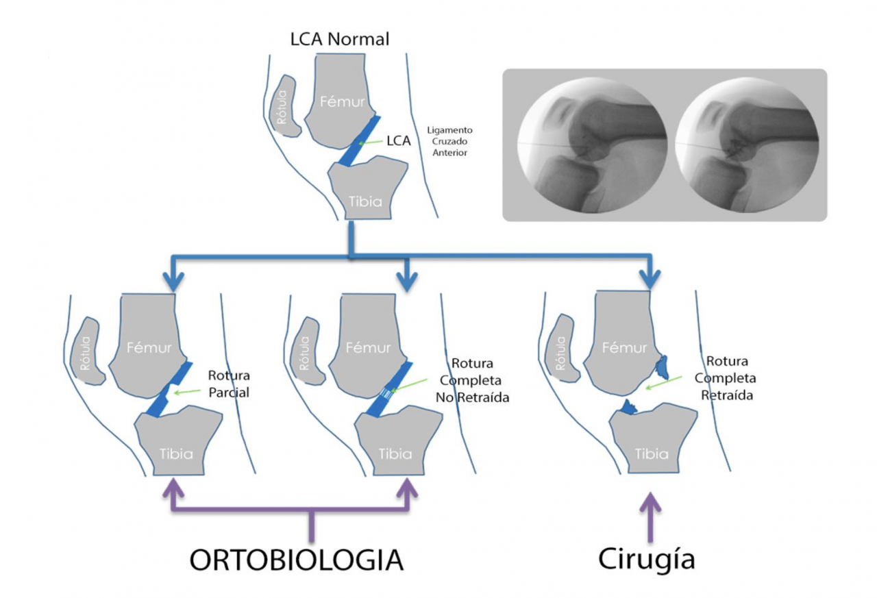 Rotura parcial del ligamento cruzado anterior (LCA). Tratamiento sin ...