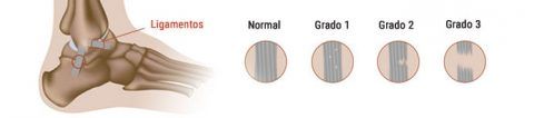 ¿Cómo saber si tengo una lesión de ligamentos? - ITRAMED